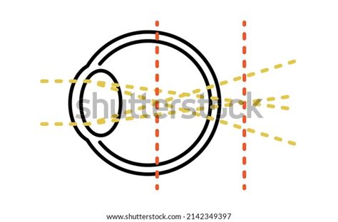 Medical Illustration Visual Acuity Refractive Error Stock Vector Royalty Free 2142349397