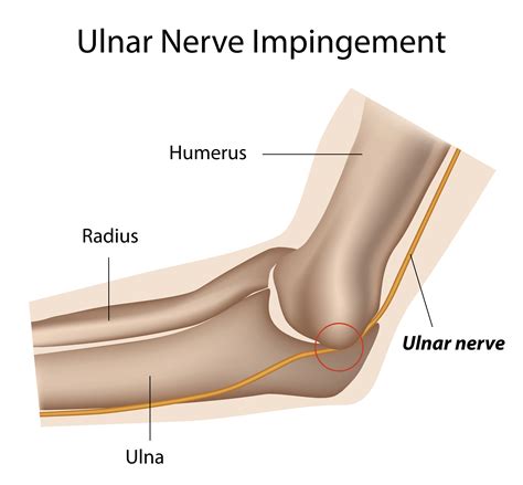 Ulnar Nerve Entrapment At The Elbow