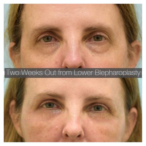 Dallas Fat Transfer Upper And Lower Blepharoplasty Eyelid Surgery