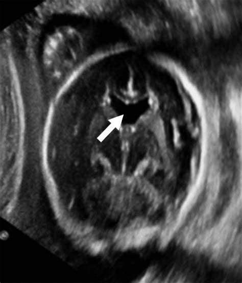 Abnormalities Associated With The Cavum Septi Pellucidi On Fetal Mri