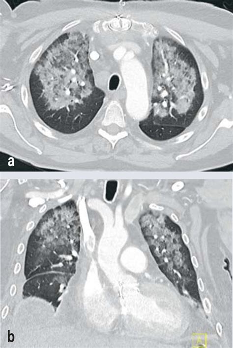 Daptomycin Induced Eosinophilic Pneumonitis Pmc