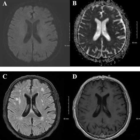 Axial Dwi A With No Signal Rich Areas And Axial Adc B With