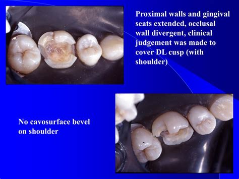 Ppt Porcelain Inlay And Onlay Powerpoint Presentation Free Download