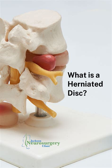 What Is A Herniated Disk Artofit