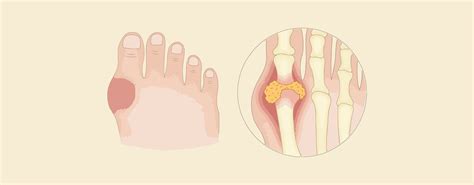 Exploring The Difference Between Septic Joint And Gout Causes Symptoms Diagnosis And
