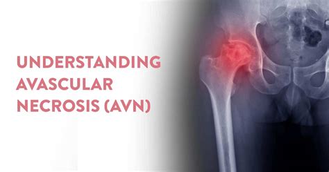Know Role Of Core Decompression In Avascular Necrosis Avn Ck Birla Hospital
