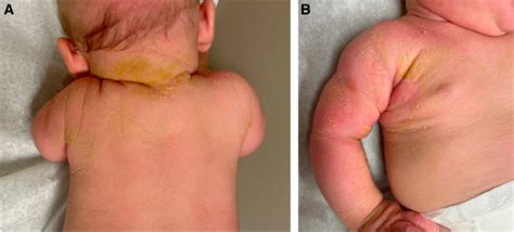 Epidermolytic Ichthyosis In A Neonate The Journal Of Pediatrics