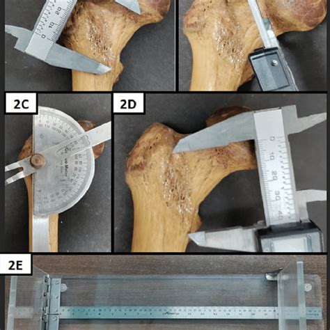 Measurements Of Different Parameters Of The Proximal End Of The Femur