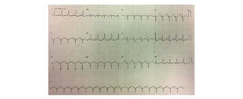Electrocardiogram Showing Pacemaker Stimulated Ventricular Rhythm And