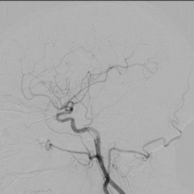 Example Of DSA Showing A Lateral View Of Contrast Enhanced Brain Download Scientific Diagram