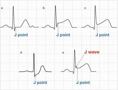 J Point Ecg Interval • Litfl • Ecg Library Basics