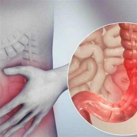 Dont Overlook These 6 Warning Signs Of Stage 1 Colon Cancer