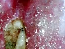 Maggots Tube Search Videos
