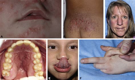 Primary Immunodeficiency Update Journal Of The American Academy Of