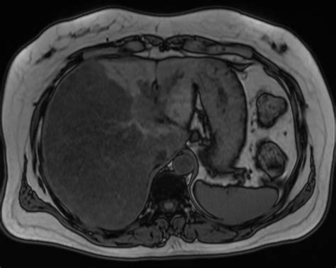 Liver Atlas Diagnosis Cholangiocarcinoma