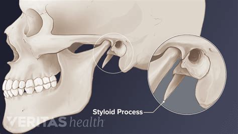 Styloid Process Post Operative Ct Image Styloid Process Was Removed