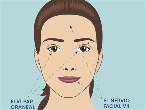 sindrome de moebius