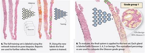 pathologist level gleason grading using artificial intelligence ai