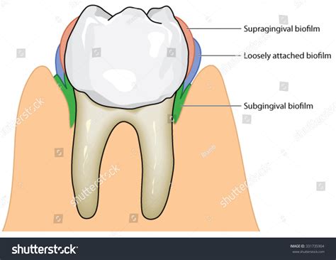 What Is Gingival Margin At Marcellus Meyers Blog