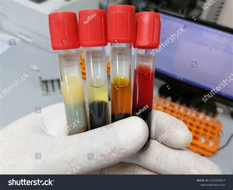 Blood Sample Icterus At Clifford Ward Blog