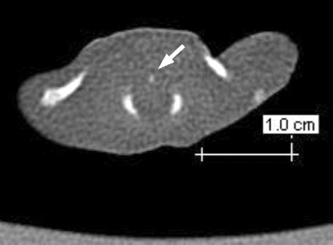 Foetus Aged 12 Weeks Ossification Centres For Vertebral Centrum