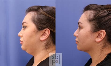 Laser Lipo Under Chin At Greg Booth Blog