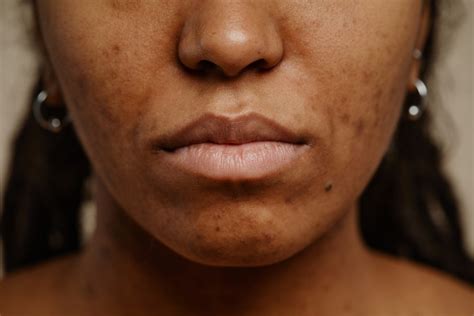 Hyperpigmentation Treatment For Black Skin Uk Guide Products And Causes