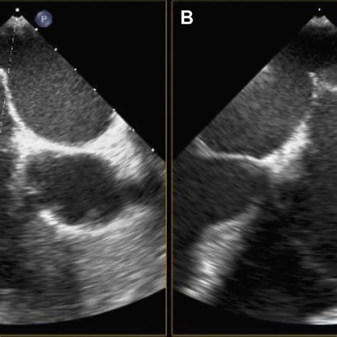 A Lasso Catheter Biosense Webster Irvine Ca In The Pulmonary Vein