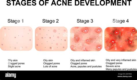 Pimple Healing Stages Stages Of A Pimple The Complete Guide Kpxmaw