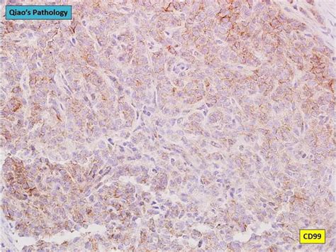 Adult Granulosa Cell Tumor Immunostains Cd99