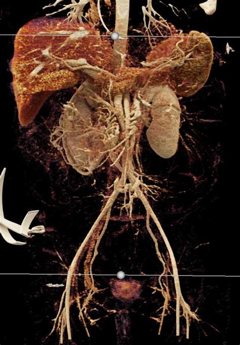 Small Bowel Obstruction With Cinematic Rendering Small Bowel