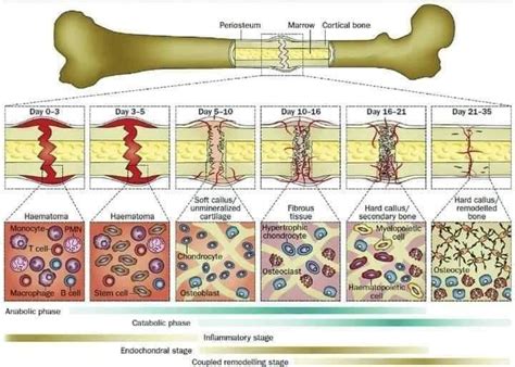 Saeed Ahmad Pt Dpt On Linkedin Fracture Healing A Fracture Is A Break In A Structural