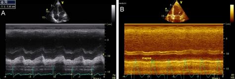 Mitral Annular Plane Systolic Excursion A Normal B Severe Systolic