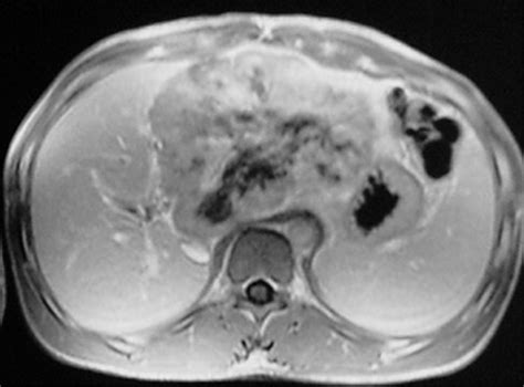 Peripheral Cholangiocellular Carcinoma Eurorad Peripheral Cholangiocellular Carcinoma Eurorad