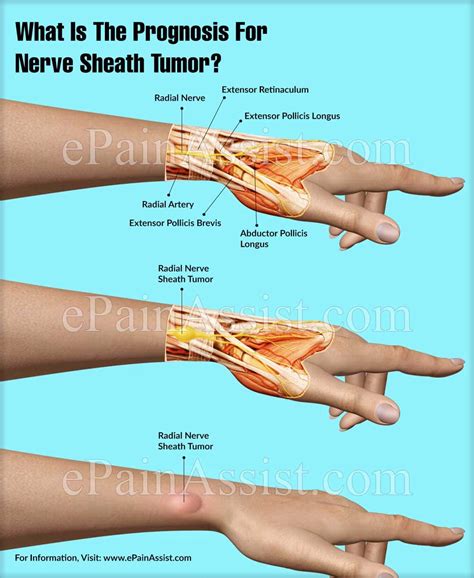 What Is The Prognosis For Nerve Sheath Tumor