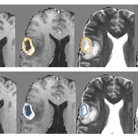 pdf sequential 3d u nets for biologically informed brain tumor