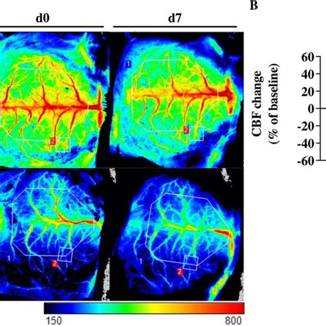 Bilateral Carotid Artery Stenosis Led To A Persistent Decrease In