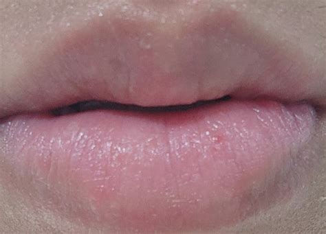 입술 튼거 질문 지식in