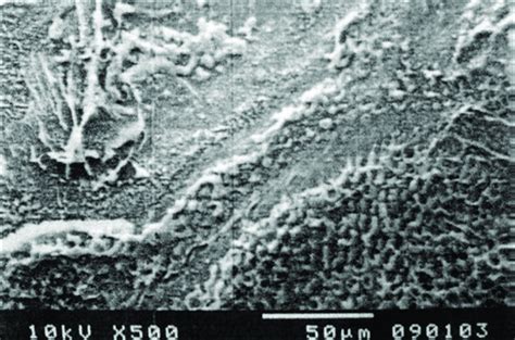 Deproteinization Of Tooth Enamel Surfaces To Prevent White Spot Lesions And Bracket Bond Failure