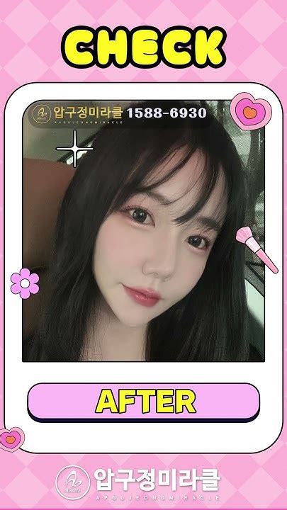 실리프팅 받고 외모췌엑 외모체크 외모췍 외모체크챌린지 실리프팅전후 Shorts 시술후기 비포앤애프터 안면거상