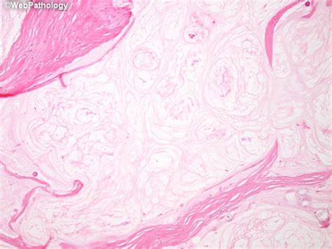 Mucinous Carcinoma Of Breast