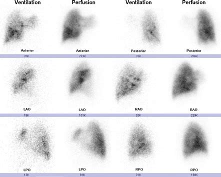V Q Scan Radiology Reference Article Radiopaedia Org