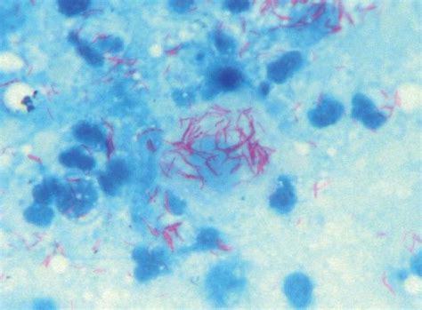 Figure From Classification Of Mycobacterium Tuberculosis In 55 Off