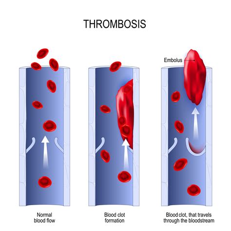 Thrombosed Vein