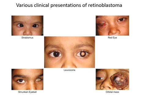 Retinoblastoma What Patients And Caregivers Should Know About Oncodaily