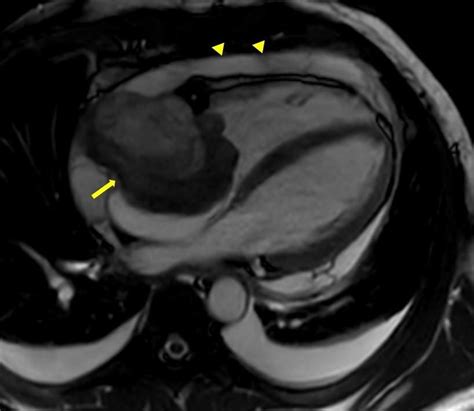 A Case Of A Cardiac Angiosarcoma Eurorad