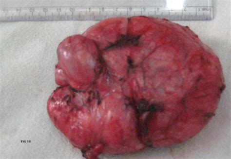Figure 3 From Giant Calcifying Fibrous Pseudotumor Of The Neck A Case Report Semantic Scholar