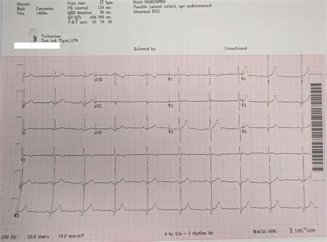 Ecg With Possible Lateral Infarct Askdocs