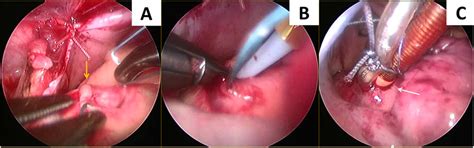 Aortic Cannulation Through The Chest Wall Into The Ascending Aorta A Download Scientific