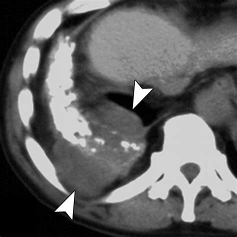 Pyothorax A Unique Case Of Tension Empyema Caused By Prevotella
